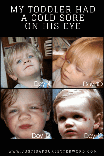 How to Spot a Toddler Cold Sore - Our Story and How We Treated It